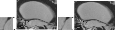 two images from a brain cine mri sequence a first image of the download scientific diagram