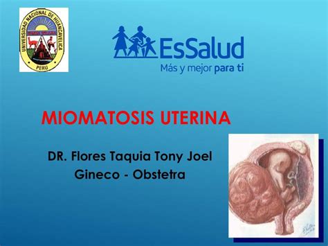 Miomatosis Uterina Gineco Jamil Edison Candiotti Fernandez Udocz