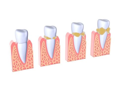 Sabes qué es y cómo prevenir la placa dental Clínica Dental Fibemedic
