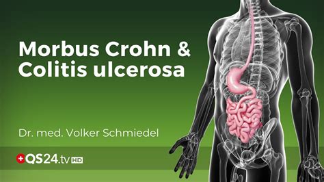 Morbus Crohn Und Colitis Ulcerosa Wirklich Unbekannte Ursache Dr