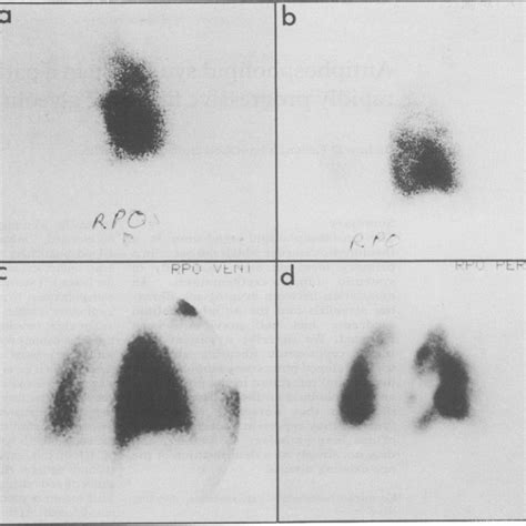 Entilation Perfusion Lung Scans At Initial Presentation Ventilation