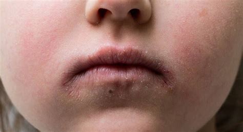 Atopijski Dermatitis I Ekcemi Kod Beba I Dece Uzroci Simptomi