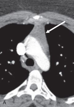 Mediastinum Chest Wall And Diaphragm Radiology Key