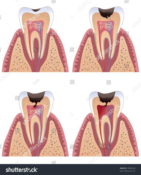 Human Tooth Structure Vector Diagram Caries Stages Dental Anatomy Tooth