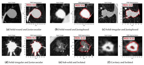 sensors free full text lung nodule segmentation with a region based fast marching method