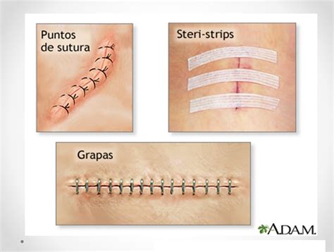Tipos De Suturas