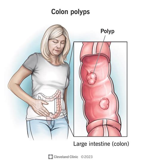 Colon Polyps Symptoms Causes Types Removal