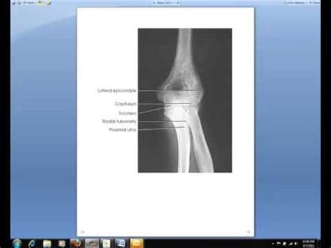 Trauma Ap Elbow Partial Flexion Youtube