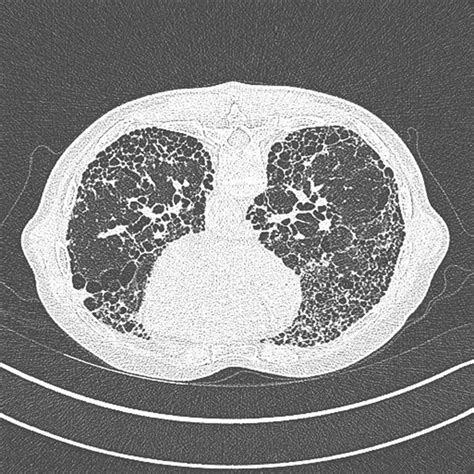 Computed Tomography Imaging Of The Chest Displaying Extensive Usual