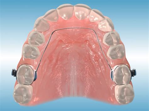 Orthodontic Appliances Bright Orthodontics