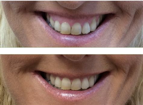 Before And After Botox Treatment For Gummy Smile Dr Teri Johnson