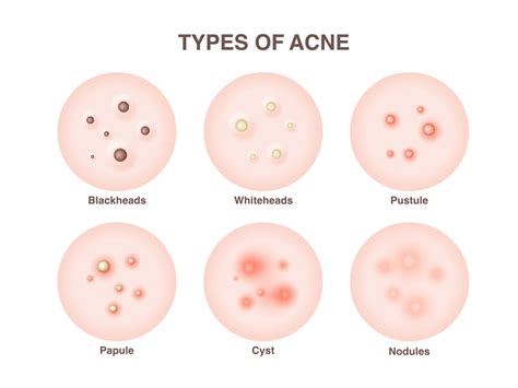 Acne What Is Acne And How To Treat It