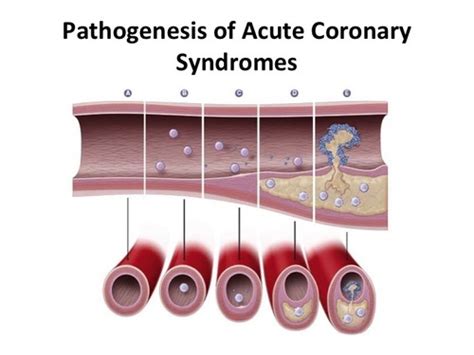 Acute Coronary Syndrome Flashcards Quizlet
