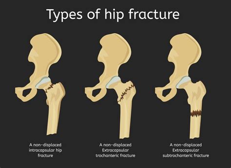 Understand Bone Fractures Causes Treatment Symptoms Zealmax