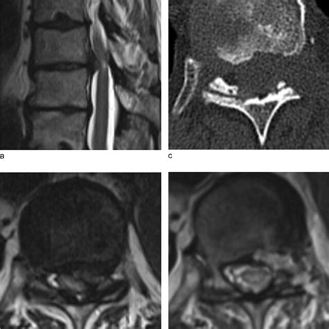 A B Preoperative Sagittal And Transversal MRI Images For A Calcified