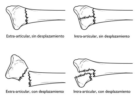 Fracturas Distales Del Radio Mu Eca Quebrada Distal Radius Fractures