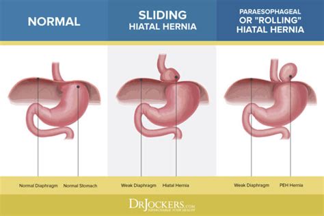 Hiatal Hernia Symptoms Causes And Natural Support Strategies