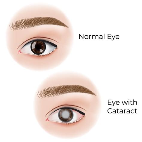 Focal Point Vision Cataract Surgery
