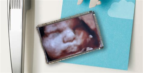 Ultrasound Direct 4D Bonding Scan Available From 24 34 Weeks