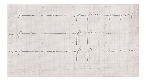 ECG Sinus Rhythm First Degree AV Block Intraventricular Conduction