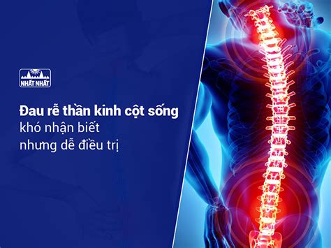 Đau rễ thần kinh cột sống khó nhận biết nhưng dễ điều trị