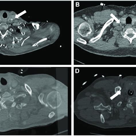 Representative Computed Tomography Angiography Images Of Patients With