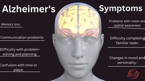 Alzheimer S Disease Top Pharmaceutical Wholesaler Exporter
