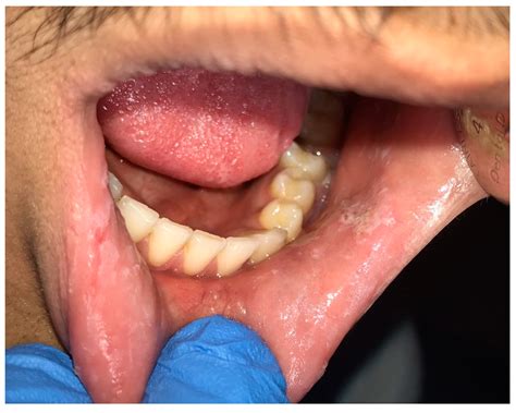 Dentistry Journal Free Full Text Oral White Lesions An Updated