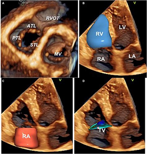 Three Dimensional Echocardiography Assessment Of The Tricuspid Valve