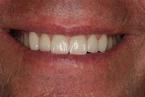 Casos Clínicos clinica dental madrid montalvo