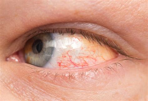 Tät Bindhinneinflammation För Allergi Upp Arkivfoto Bild av allergin
