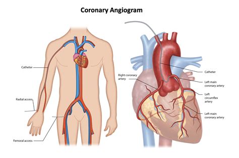 Coronary Artery Disease Melbourne Heart Group
