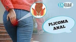 Plicoma Anal o que é e como tratar OPROGRESSONET