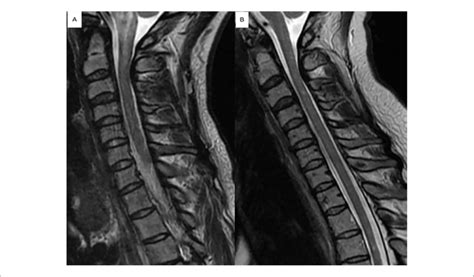 Sagittal T2 Of The Cervical Spine Showed An Abnormal T2 Hyperintense Download Scientific