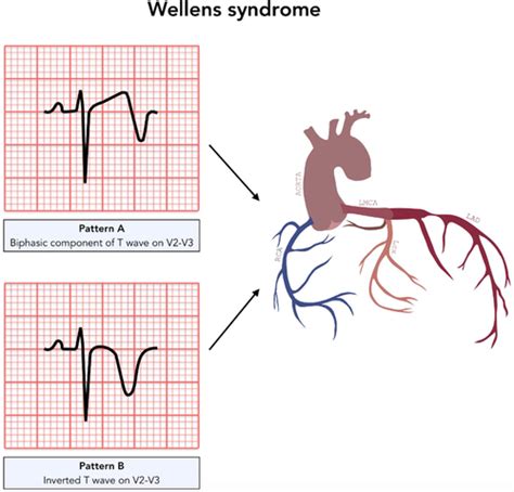 Progression From Patterns A To B In Wellens Syndrome