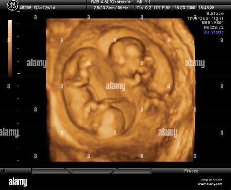 A 3D Ultrasound Scan Of A Twin Pregnancy At 12 Weeks Gestation Stock