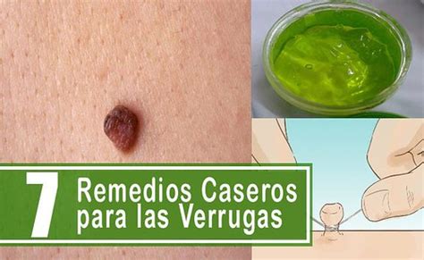 Con Estos Remedios Caseros Podrás Eliminar las Verrugas de la Piel