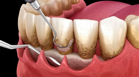Las diferentes técnicas de cirugía periodontal Malilla Dental