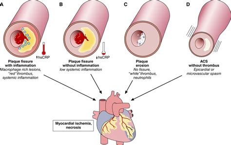 Acute Coronary Syndromes Circulation