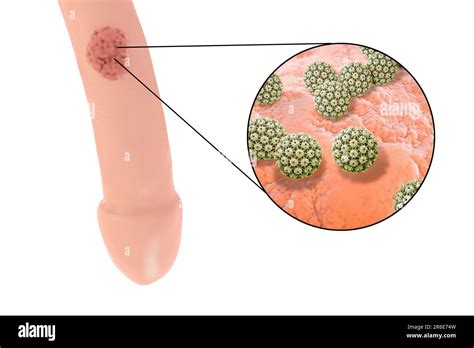Penile Genital Warts And Close Up View Of Human Papilloma Virus