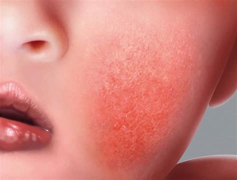 Atopische Dermatitis Verstehen Eczema Foundation