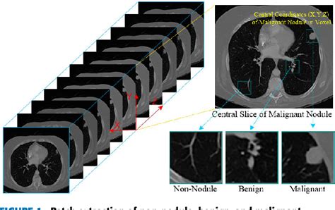 figure 1 from pulmonary nodule classification using feature and ensemble learning based fusion