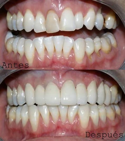 Diseño de Sonrisas Clinica de Estética Dental en Santiago