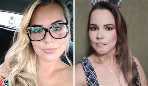 Mulher perde lábio superior após harmonização facial PMMA
