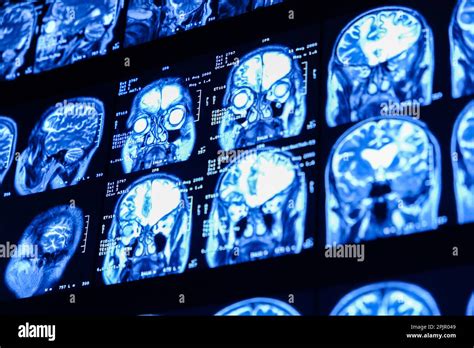 Close Up Of CT Scan With Brain Medicine Science And Education MRI