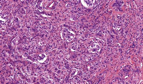 Jerad Gardner MD On Twitter RT TristanRutland7 Small Bowel Adult