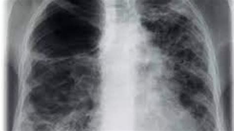 Fibrosis Pulmonar Idiopática el gran desafío del diagnóstico temprano