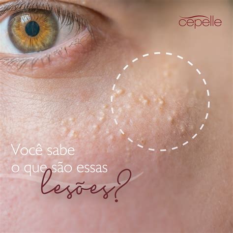 Você sabe o que são essas lesões Cepelle Dermatologia Curitiba