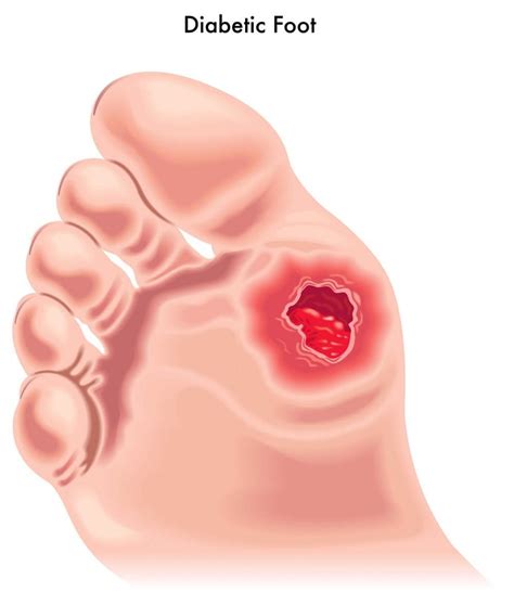Lower Extremity Wound Care A Guide Eric J Roberts DPM Podiatrist
