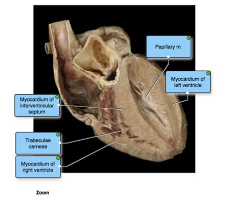 Interventricular Sulcus And Septum